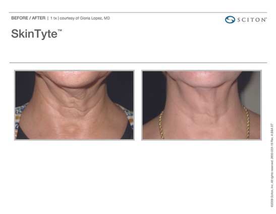 Skin Tyte | Dermatology Associates of Macomb-Oakland