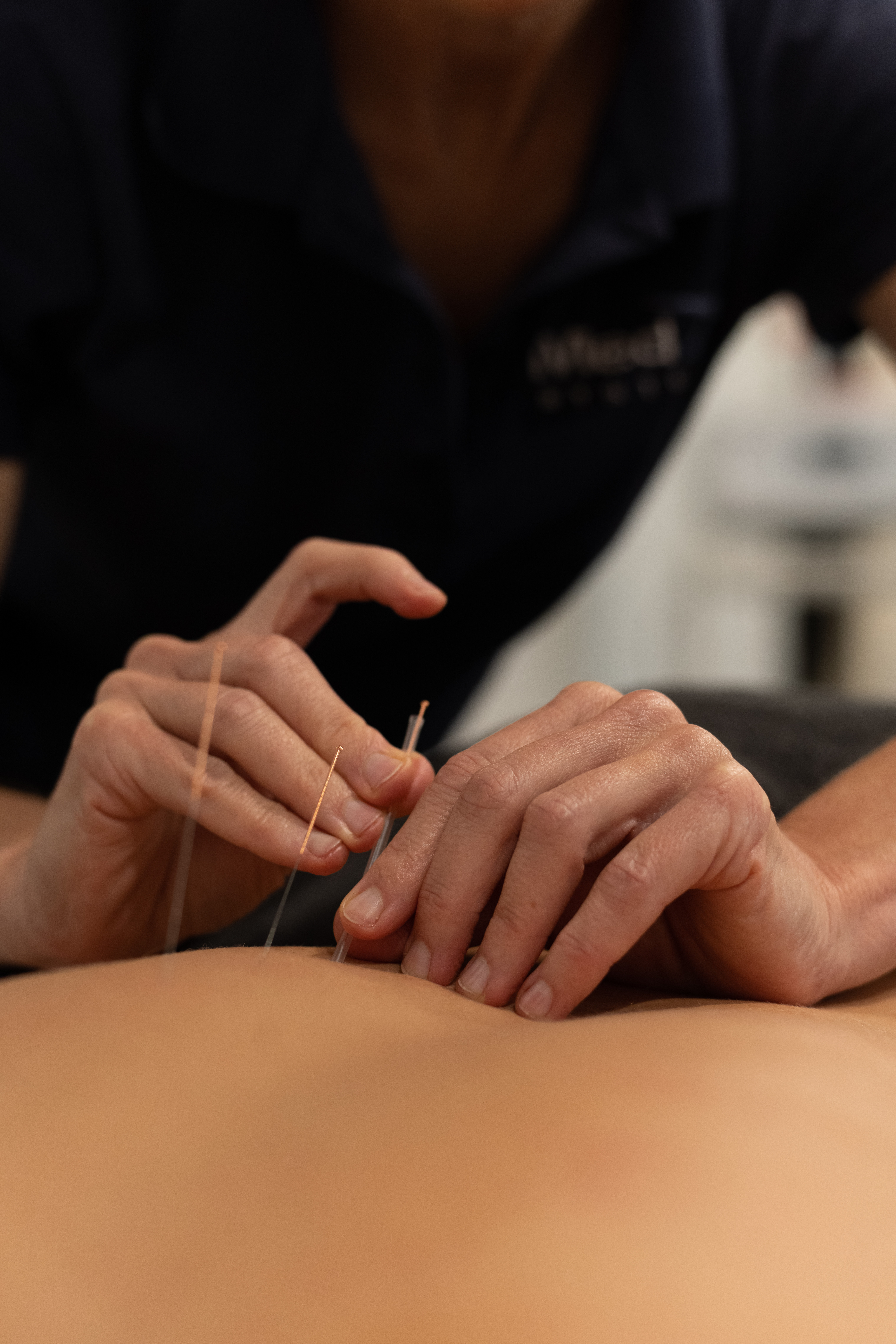 Dry Needling