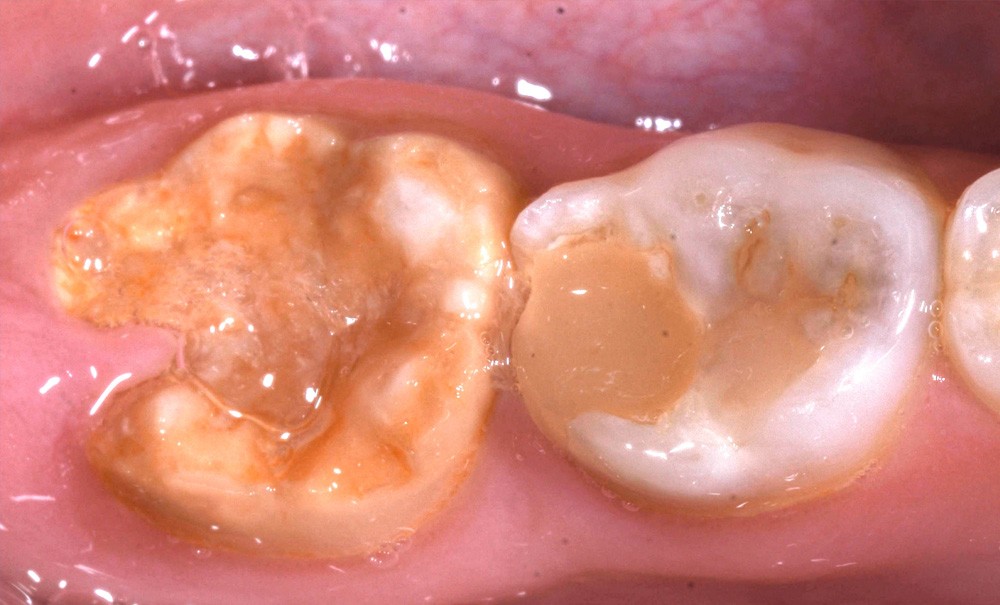 MIH dentaire : tout savoir sur l’hypominéralisation des molaires et incisives