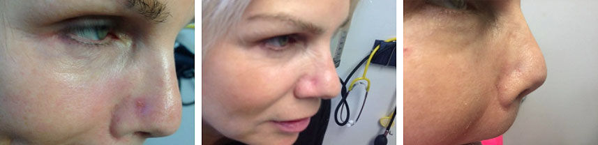 Imiquimod Topical Cream: Documented Results for Skin Cancer