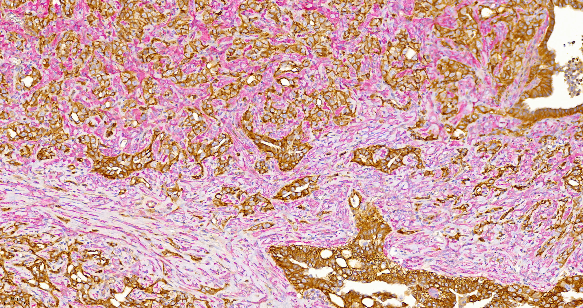 IHC Double Staining | Dual Marker Detection on a Single Slide | iHisto