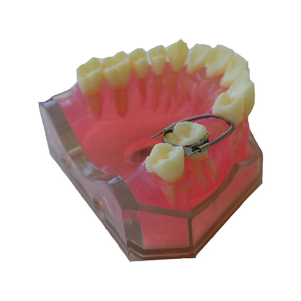 Space Regainer | J&J ORTHODONTICS