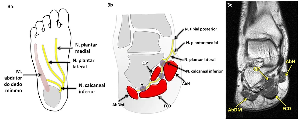 Neuropatia de Baxter