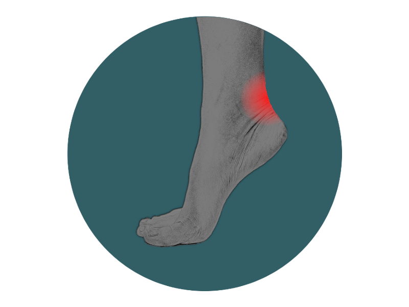 07 Achilles tendon/ Achillodynia