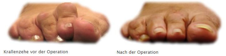 06 Krallenzehen / Hammerzehen