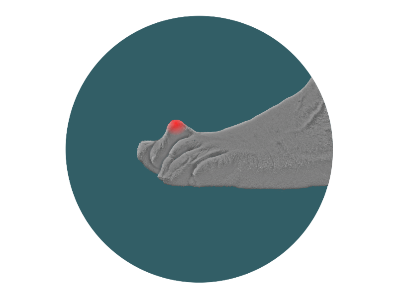 06 Krallenzehen / Hammerzehen