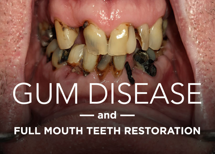 Gum Disease and Full Mouth Teeth Restoration