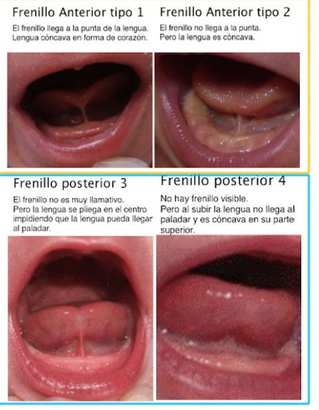 Frenillo Lingual Corto