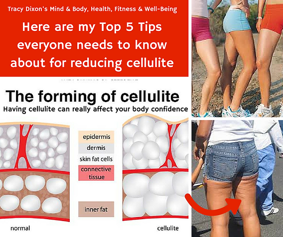 does everyone have cellulite