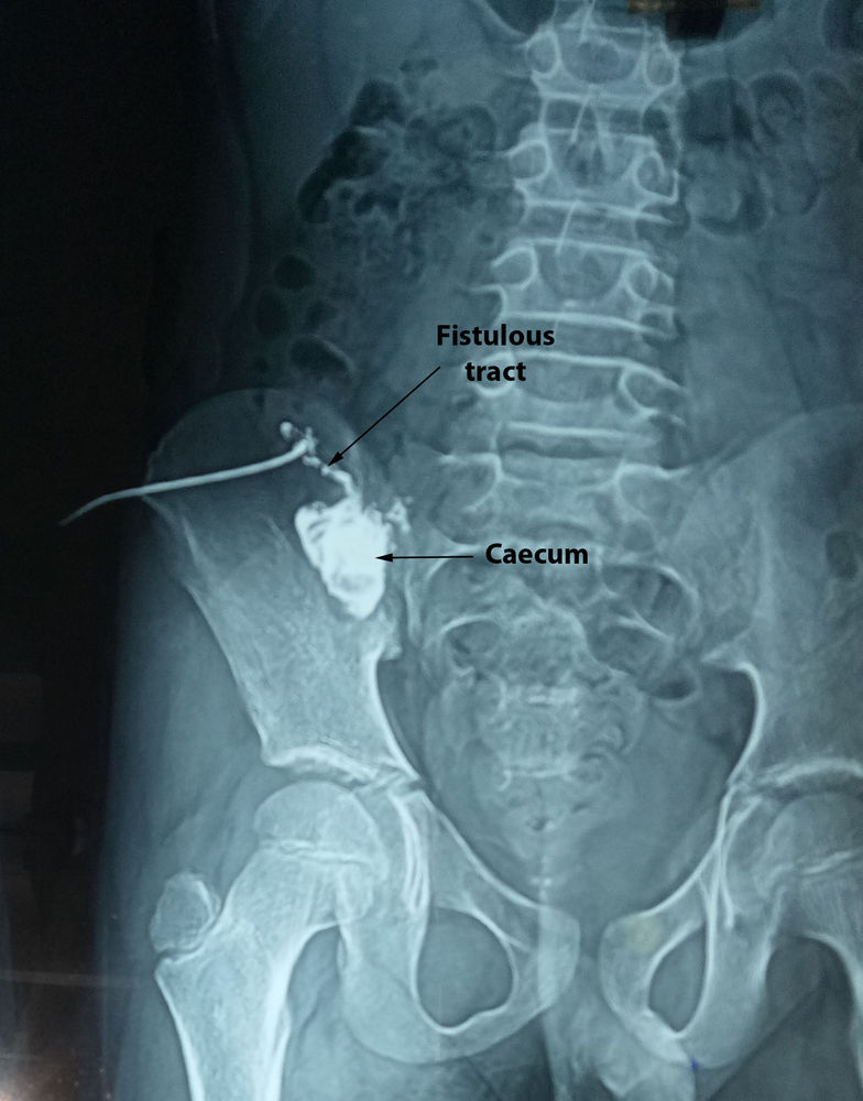 Faecal Fistula