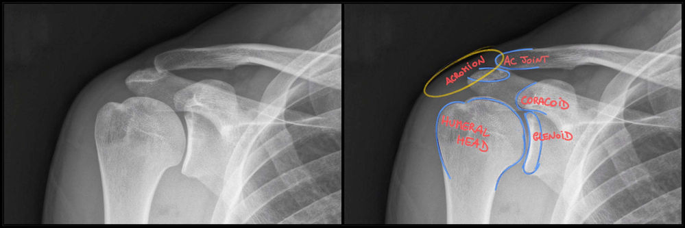 Acromion: One of the most important landmark of our body