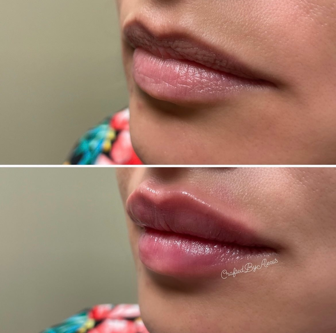Dermal Fillers | Craft Skin Clinic | Waite Park, MN