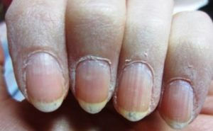 Dry Cuticle problems?
