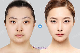 aelee plastic surgery