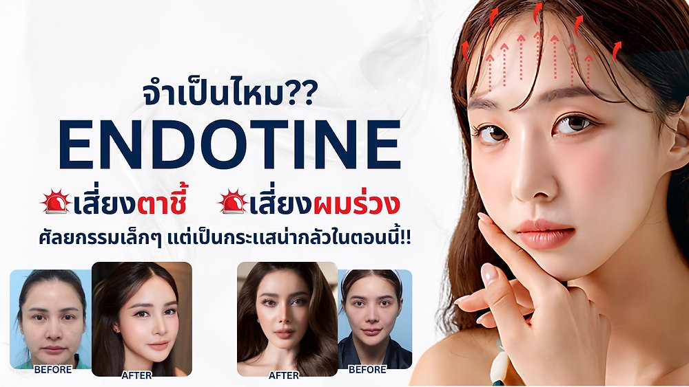 Endotine จำเป็นไหม? ศัลยกรรมเล็กๆ ที่หลายคนเริ่มกลัว แต่ว่ามันอันตรายจริงหรือ?