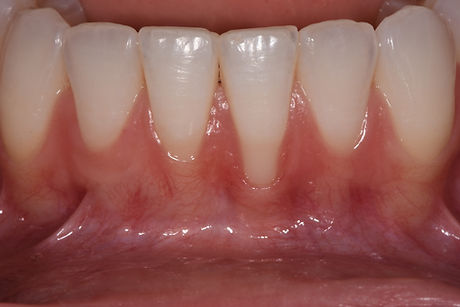 Gum Grafts | newsite