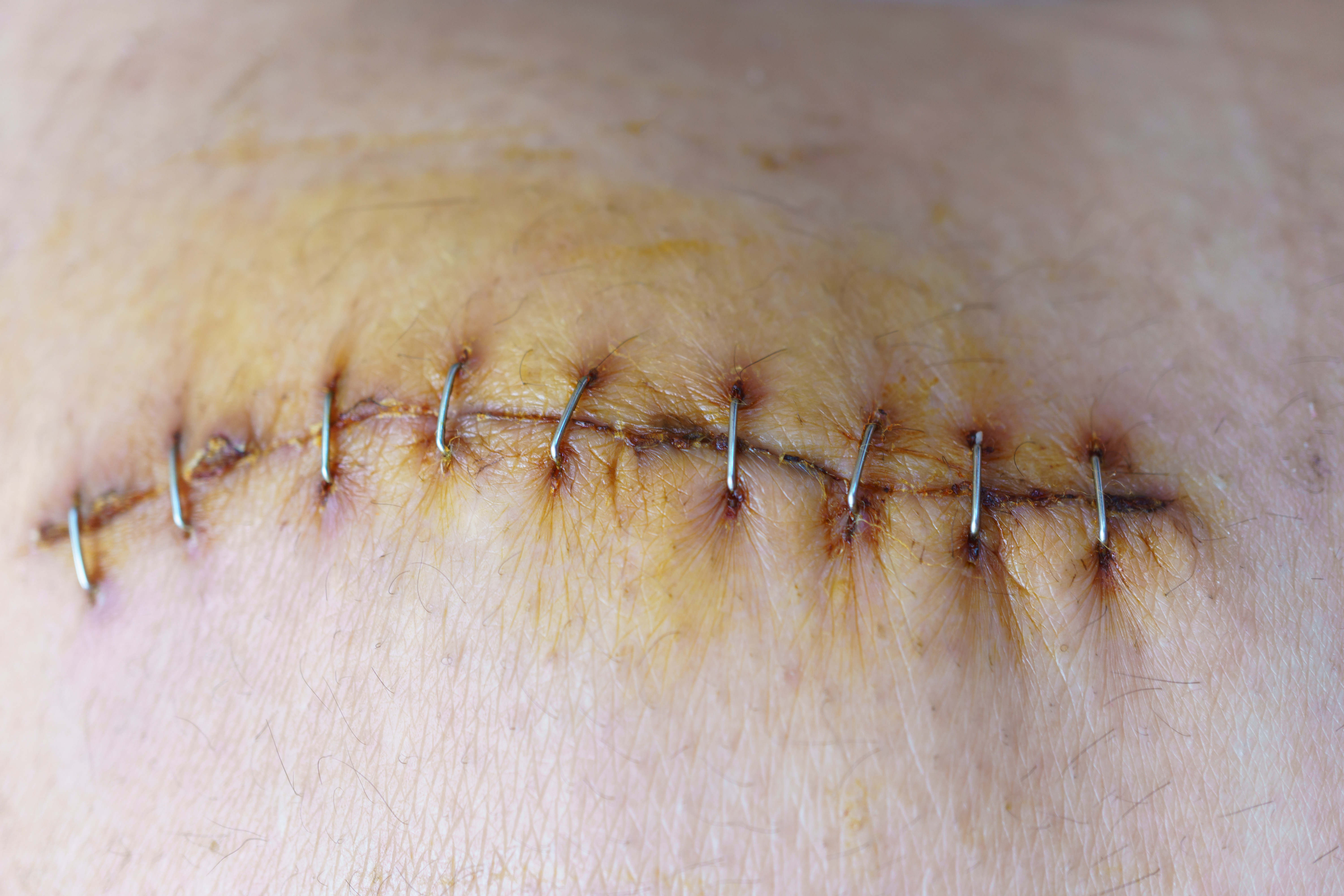incision wound