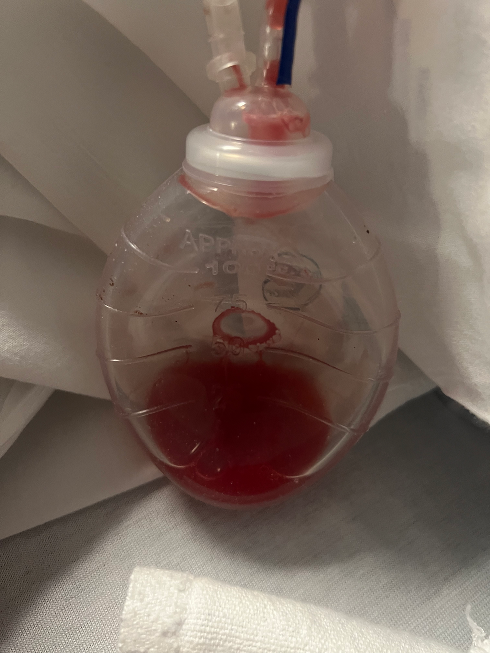 Incision and Wound Drainage After Surgery: When to Worry