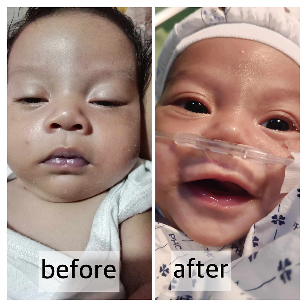 Transposition of Great Arteries with VSD and PDA: A Mother’s Fight ...