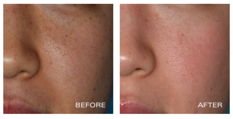 CHEMICAL PEELS | Skin Chalet