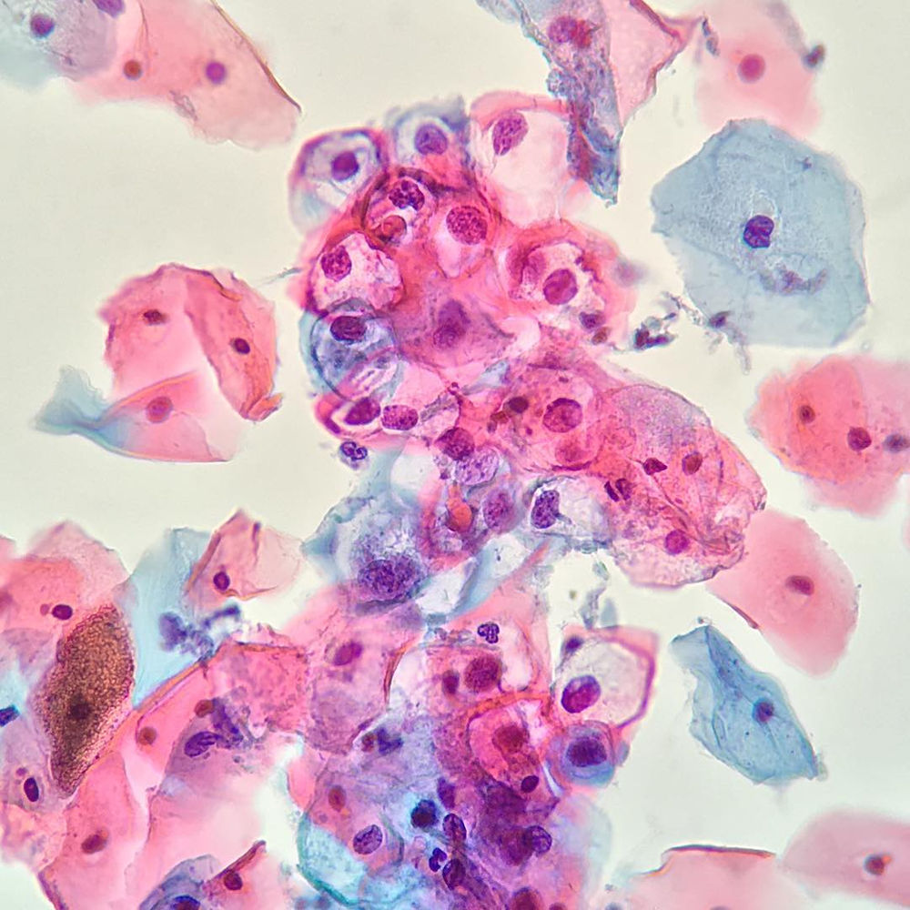 Pruebas de diagnóstico de VPH