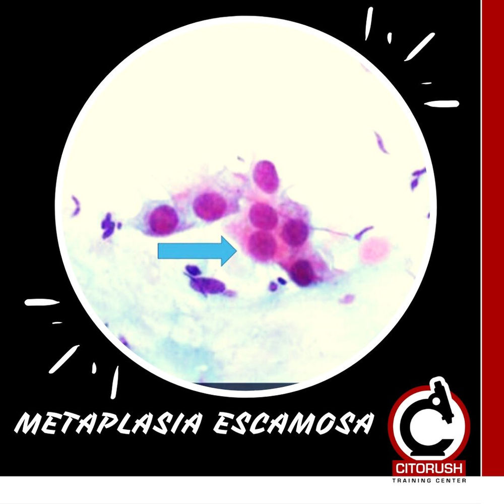 Citomorfología de la metaplasia escamosa en citología ginecológica