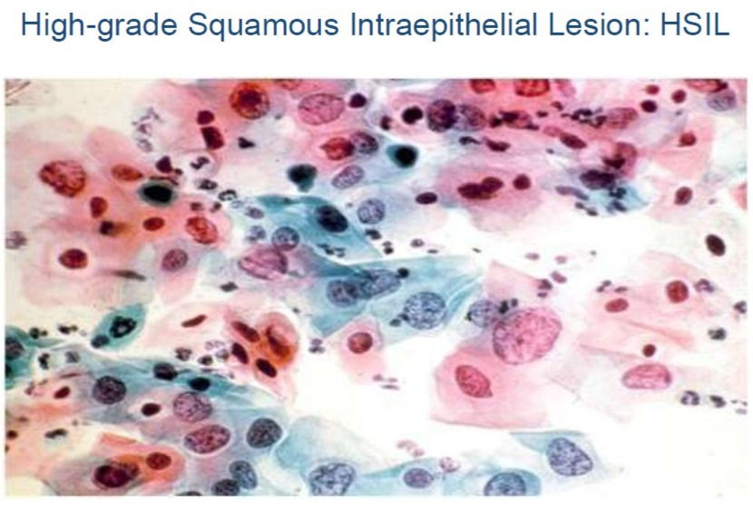 Claves citomorfológicas en el diagnóstico citológico de lesiones en Pap ...