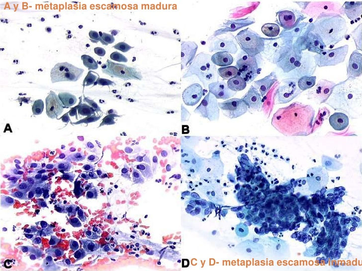 ¿Qué es la metaplasia en medicina?