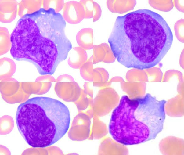 Mononucleose infecciosa