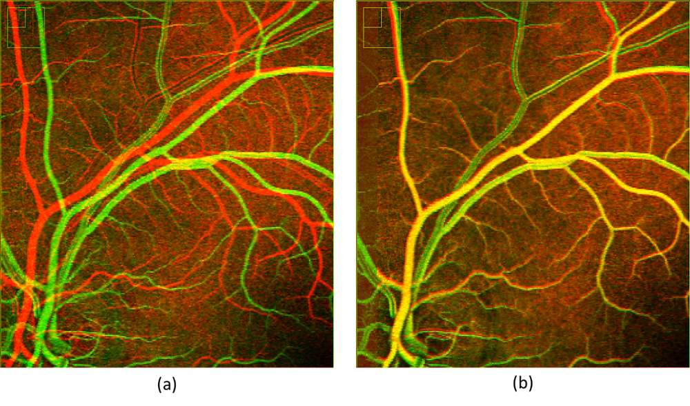 Analysis of Video Retinal Angiography with Deep learning and Eulerian ...
