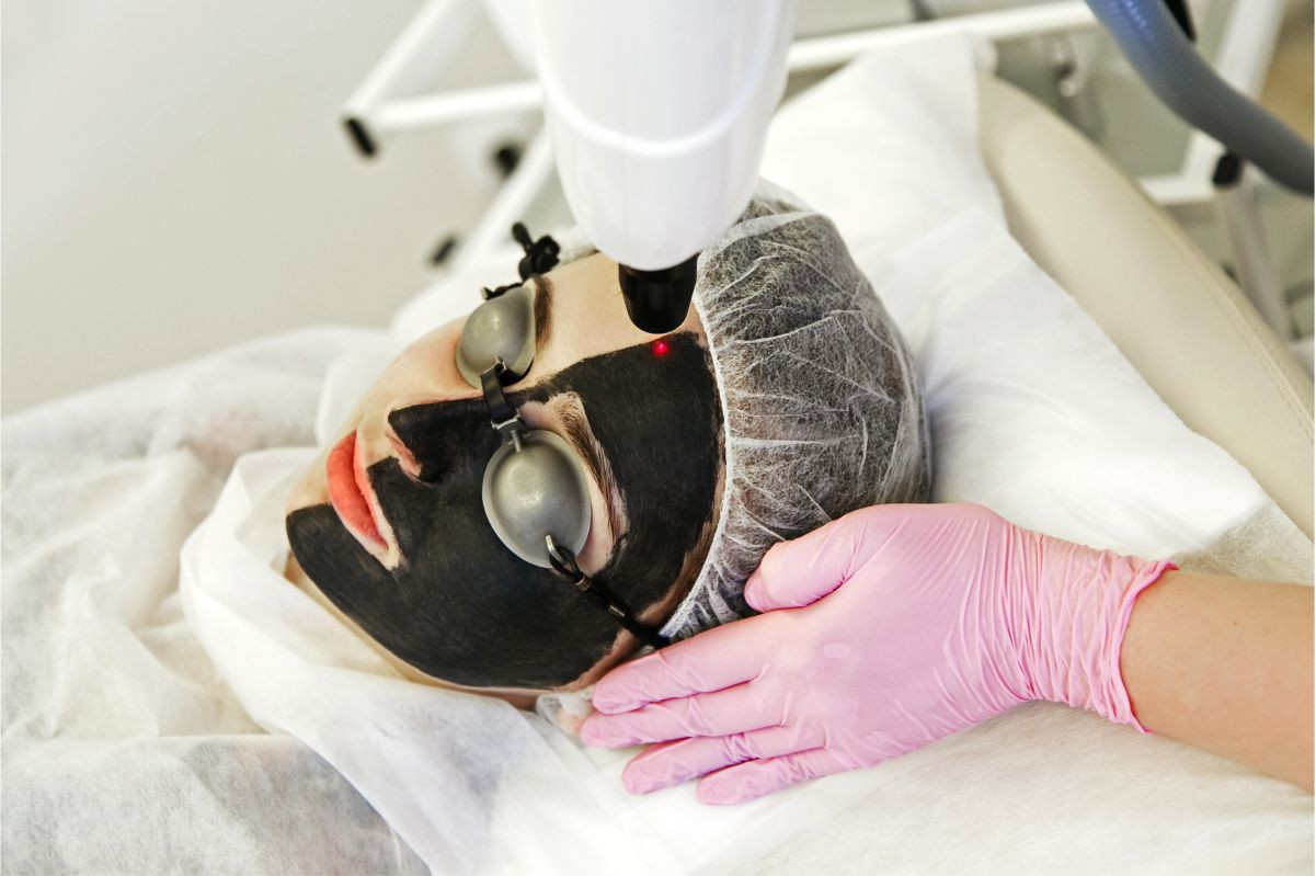 What Makes Laser Carbon Peel Ideal for Quick Glow-Ups?
