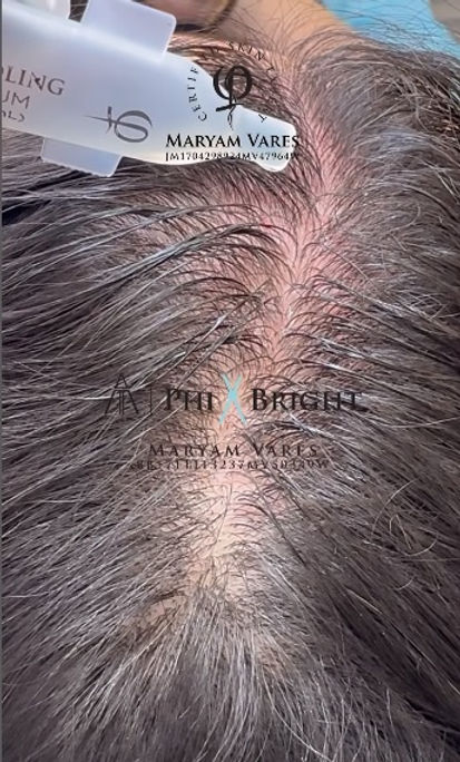 What is the best type of microneedling for Hair?