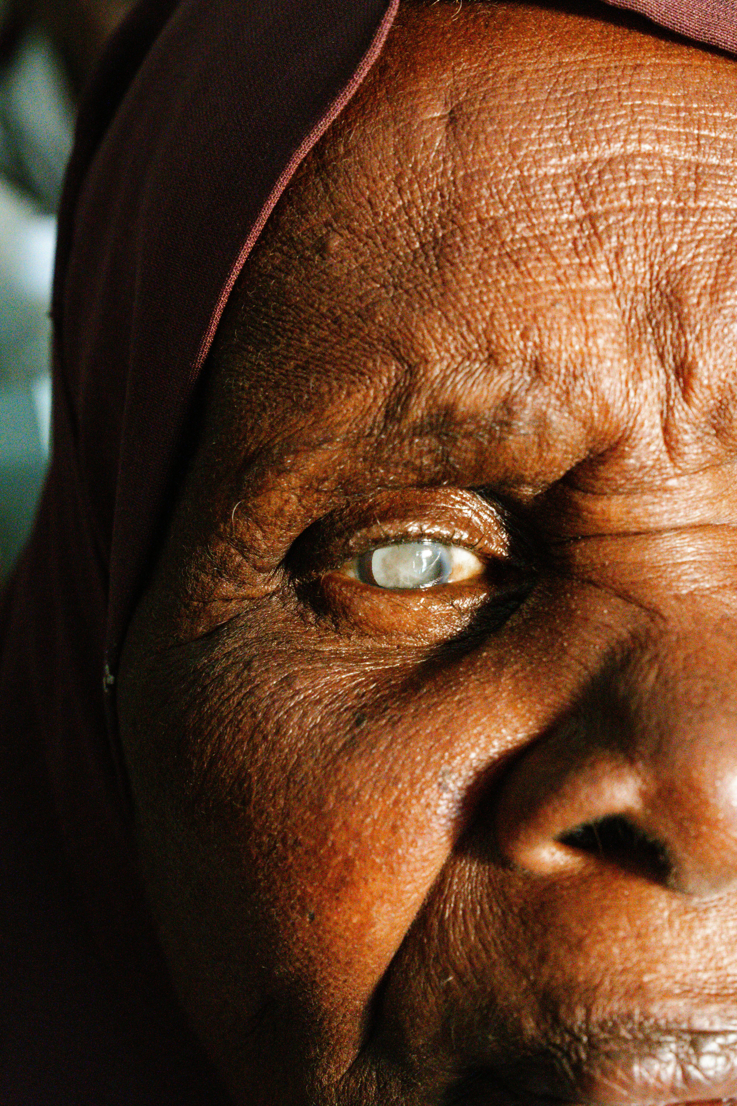 Understanding Cataracts: Symptoms, Causes, and Treatment Options