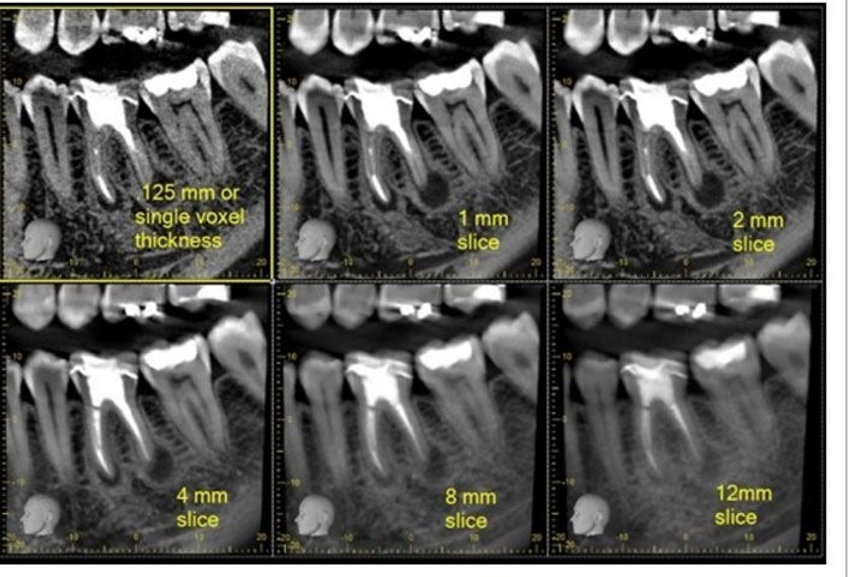 CBCT 201 – What is slice thickness and how varying it offers a ...