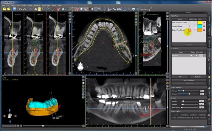 Creating a Surgical Guide With Your CBCT (And Without An Intraoral Scanner)