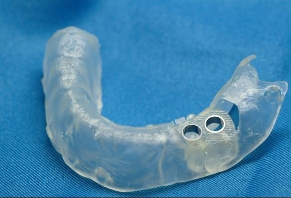 Creating a Surgical Guide With Your CBCT (And Without An Intraoral Scanner)