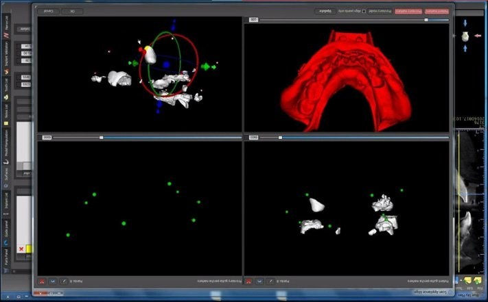 Creating a Surgical Guide With Your CBCT (And Without An Intraoral Scanner)