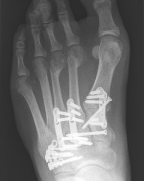 Surgical Gallery | Mr Dev Mahadevan | Foot and Ankle Surgeon, Reading