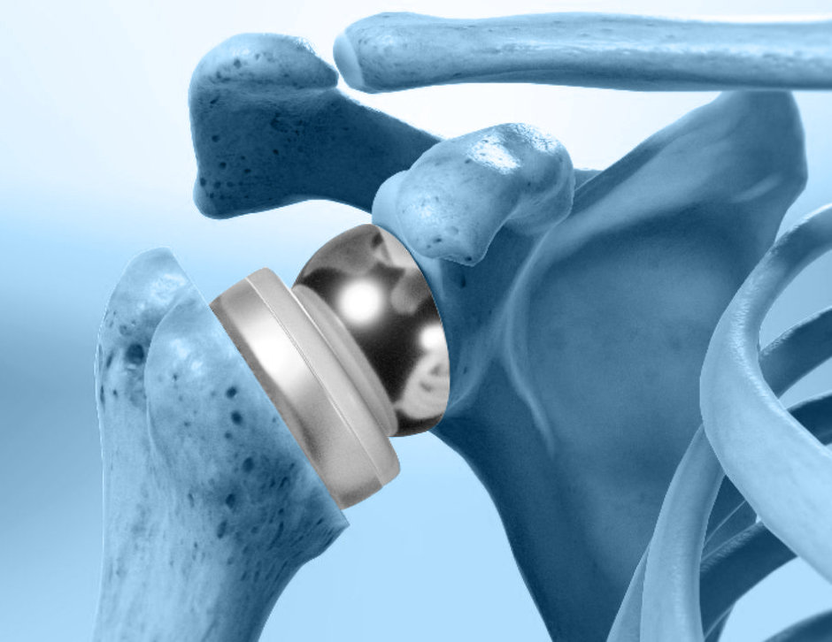 Advancements in Shoulder Replacement Surgery: A Look into Dr. Matthew ...