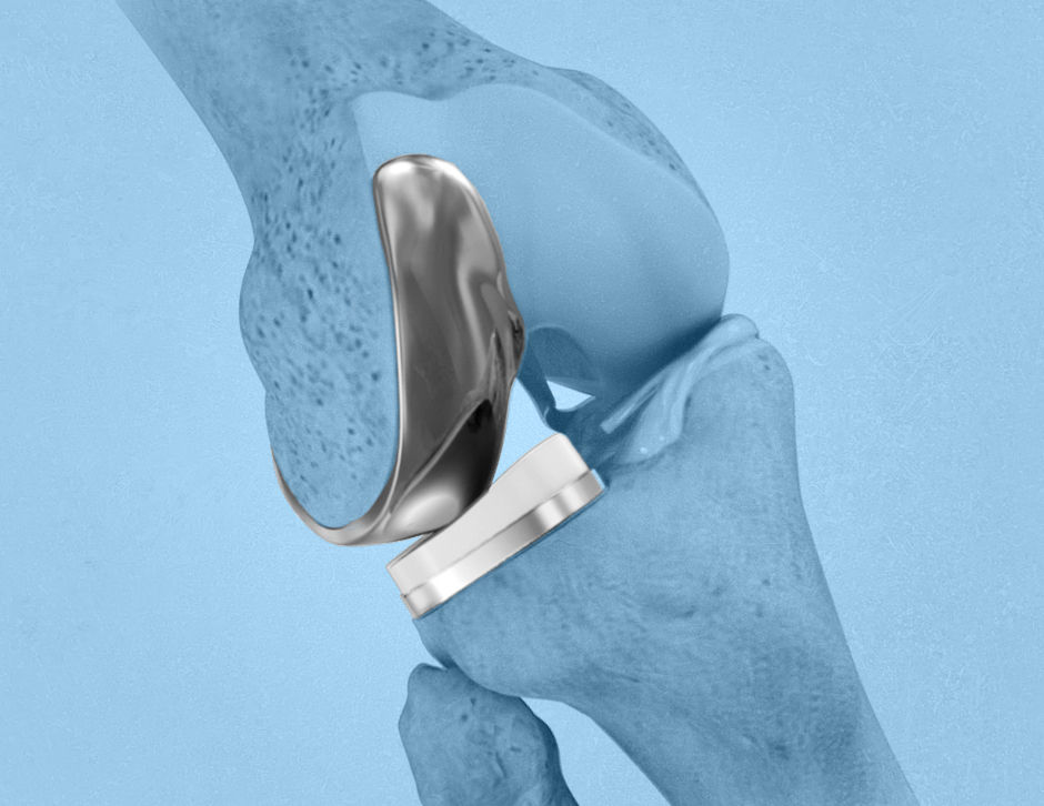 Advancements in Partial Knee Replacements: A Step Forward in Orthopedic ...