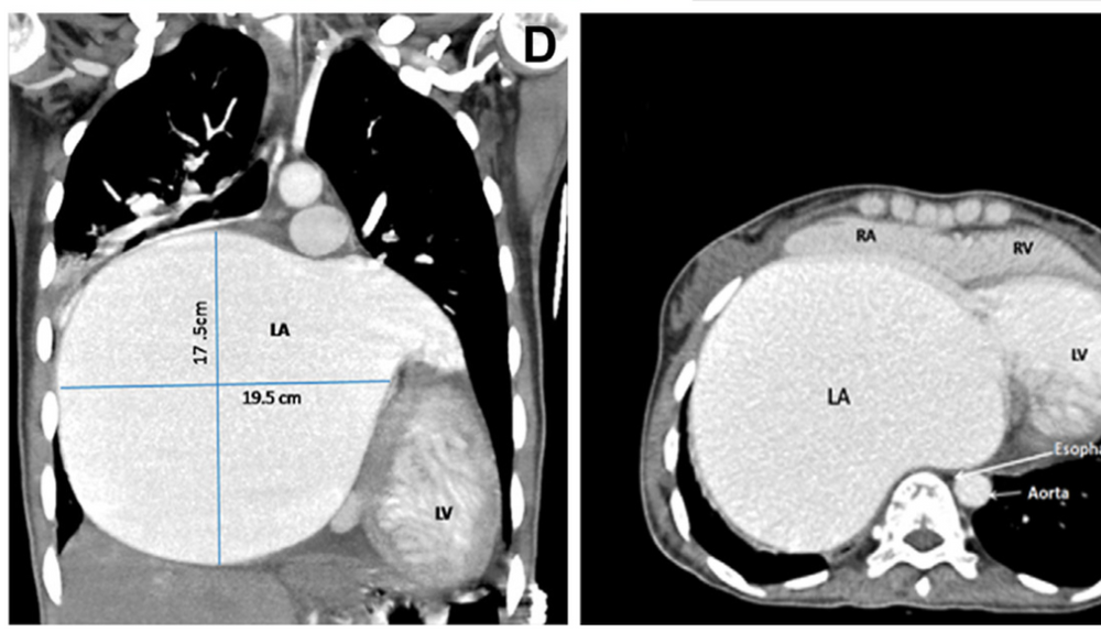 Átrio esquerdo gigante: qual a definição e quando operar?