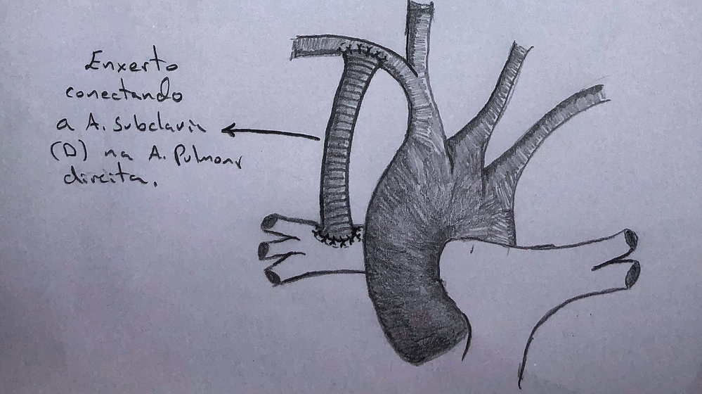 Shunt Blalock-Taussig clássico vs. modificado: indicações, vantagens e