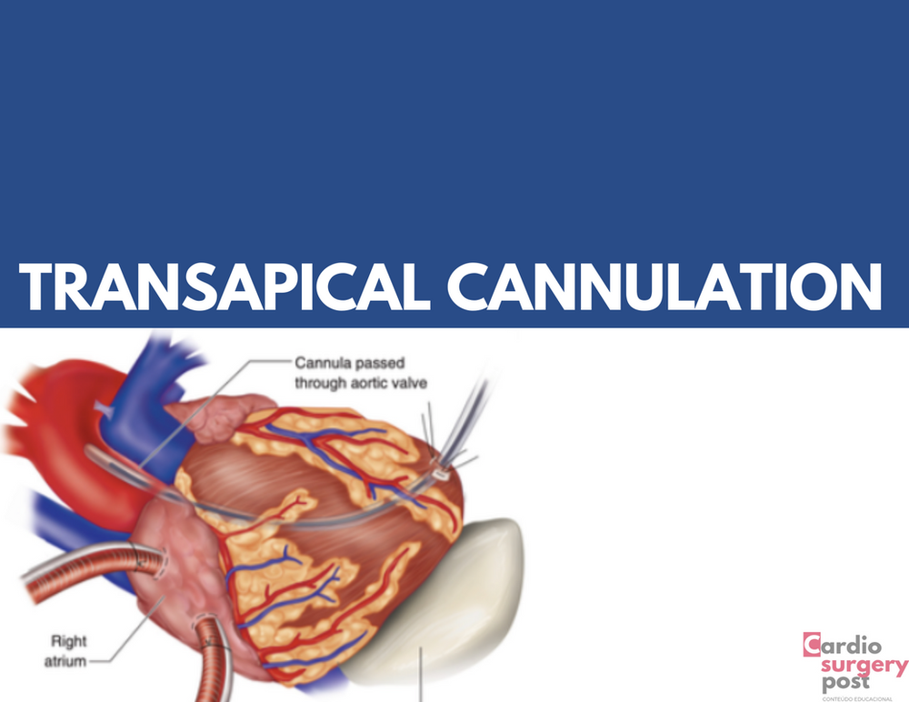 Canulação transapical: ainda é viável utilizá-la?