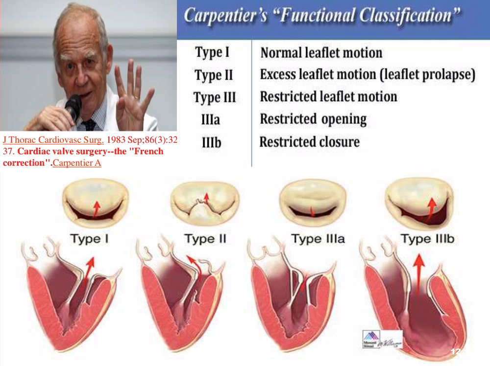 Qual A Import ncia Da Classifica o De Carpentier Na Cirurgia Da Valva Qual A Import ncia Da Classifica o De Carpentier Na Cirurgia Da Valva