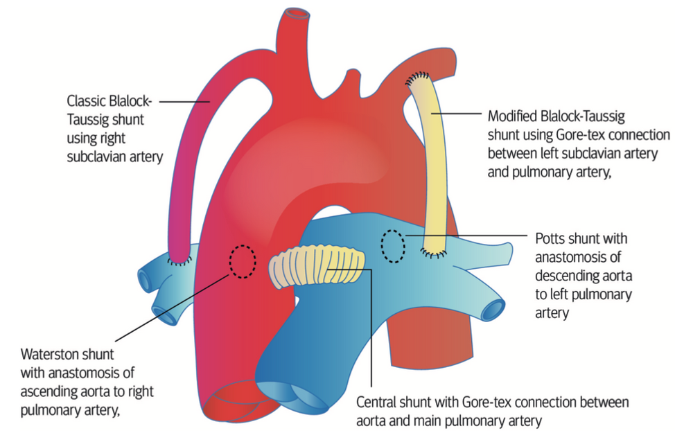 Shunt sistêmico-pulmonar: 04 conceitos básicos.