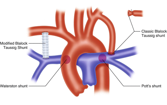 Shunt sistêmico-pulmonar: 04 conceitos básicos.