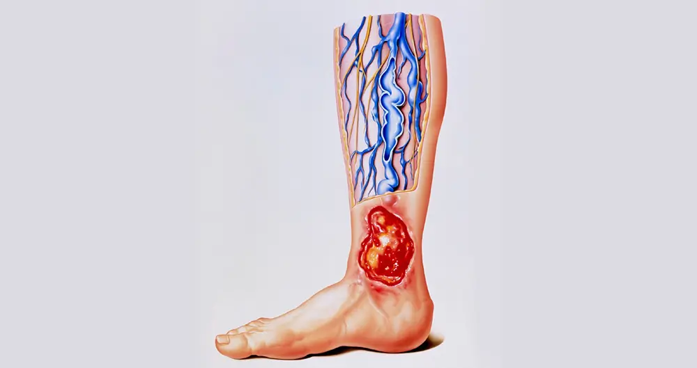 Feridas vasculares: do diagnóstico ao tratamento