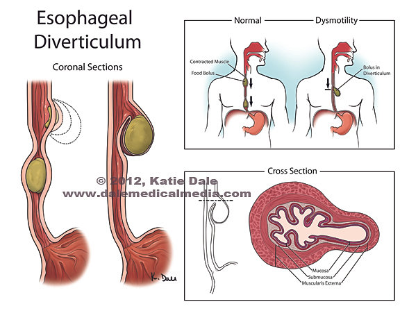 Esophageal Diverticulum Zenker's Diverticulum X Ray Wikidoc
