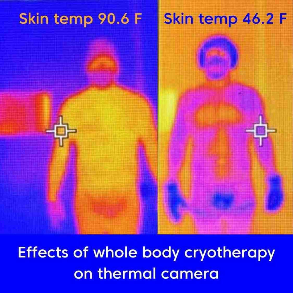 What is Cryotherapy? And why YOU should care