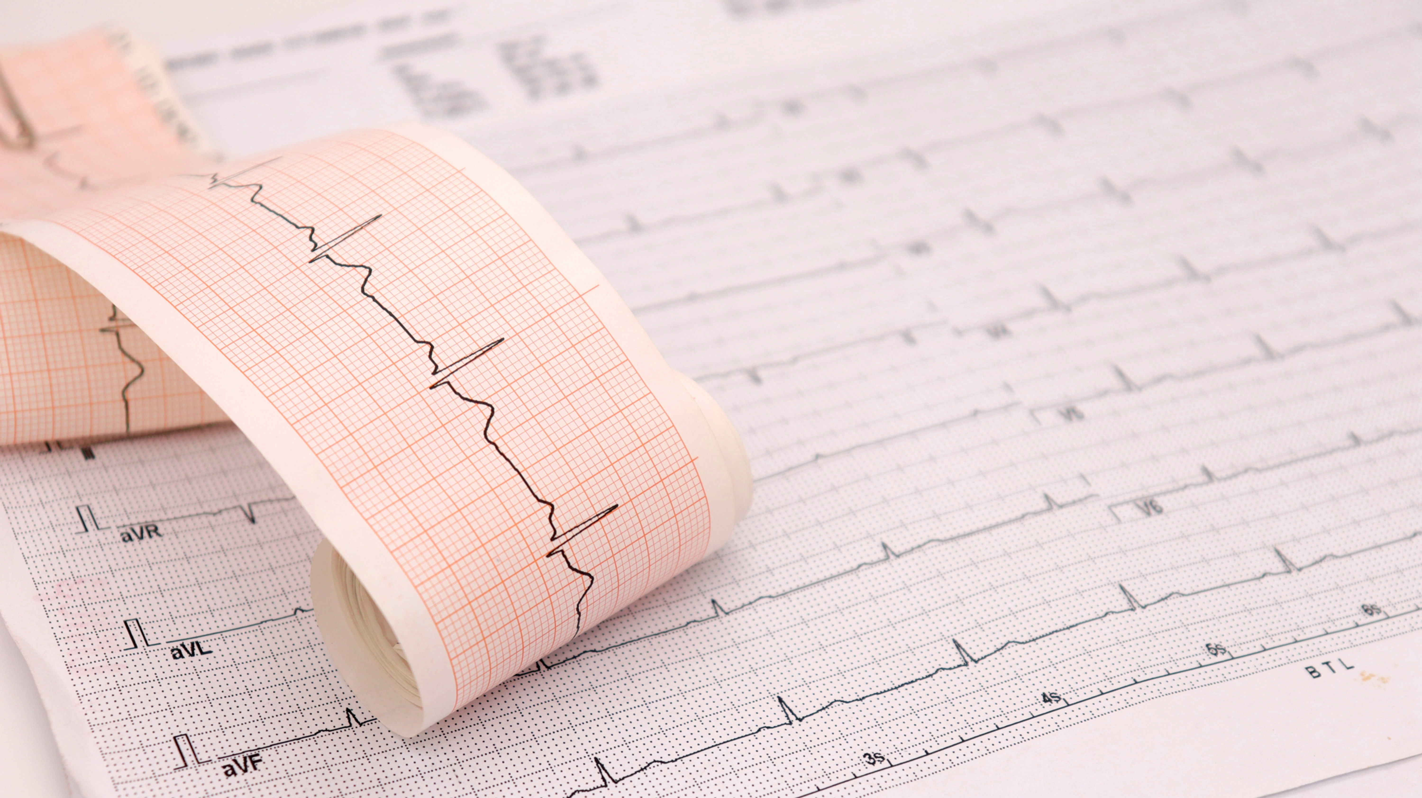 Private Electrocardiogram (ECG) Testing in Crewe, Cheshire